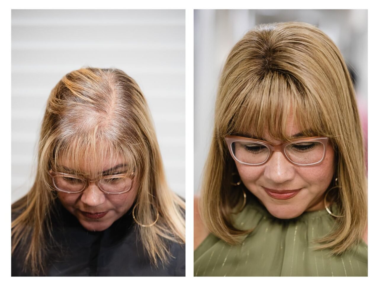 Alma Ted Treatment - HCI Hair Restoration - Orlando, FL